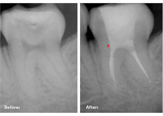 Posterior Composite Injection Over-Molding Following Root Canal ...