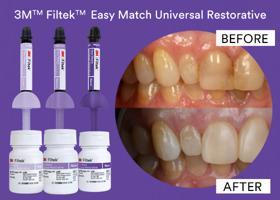 Clinical Case: Reestablishing Function and Aesthetics! | Solventum