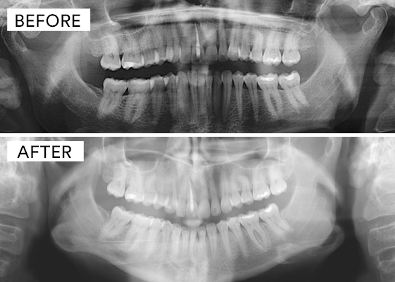 Correction of moderate overbite, class II end on occlusion on left side ...