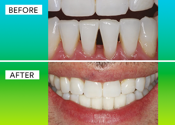 Clinical Case: Unsightly black triangles, a tricky restorative ...