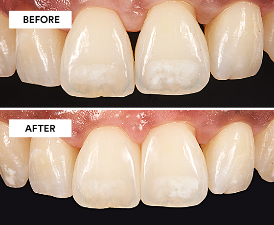 Clinical Case: Black Triangle Closure Using Bioclear© BT Matrices ...