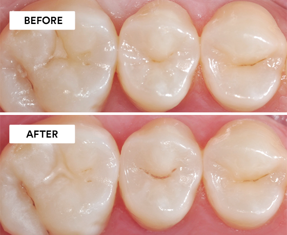 Clinical Case: Bulk Fill in Class II – Proximal Caries | Solventum