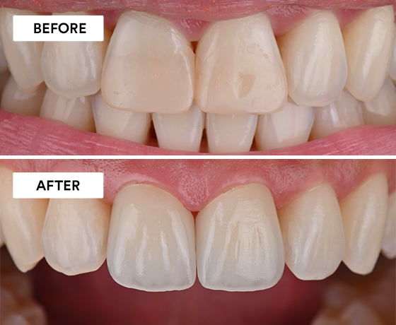Clinical Case: Esthetic anterior glass-ceramic crowns | Solventum