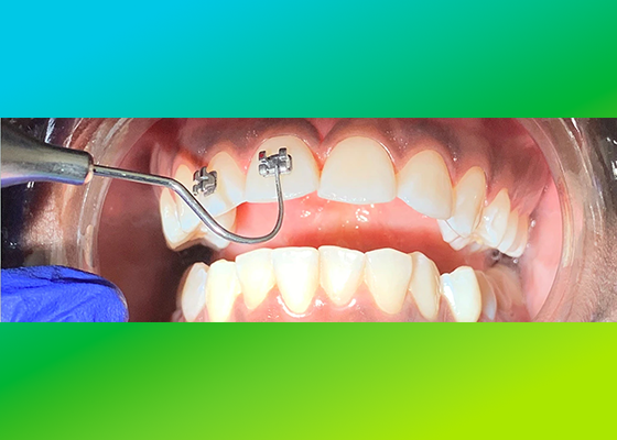 Elevate efficiencies: Why I chose 3M™ APC™ Adhesive Coated Appliances ...