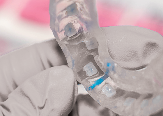 Innovations in accurate, efficient orthodontic bonding | Solventum