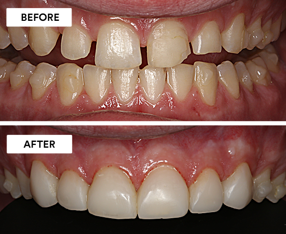 Clinical Case: Using a Digitally Designed Matrix to Enable Additive ...