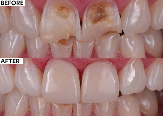 Clinical Case: Solving Esthetic Issues in the Anterior Region with ...