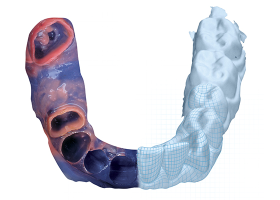 Considerations in Impressioning Methods and Material Selection | Solventum