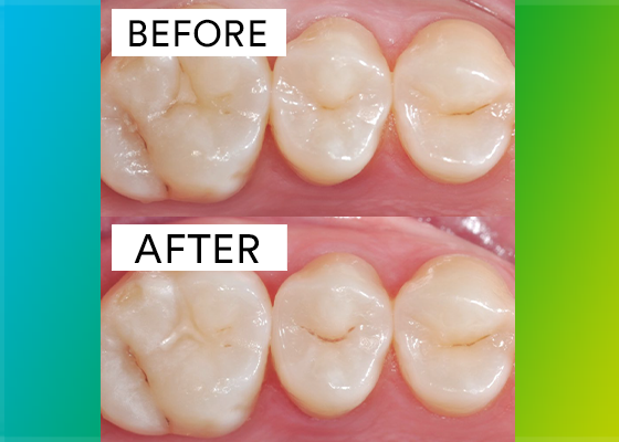 Clinical Case: Bulk Fill in Class II – Proximal Caries | Solventum