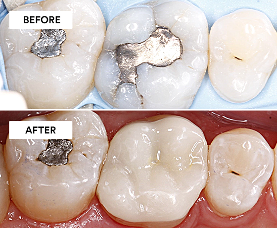 Clinical Case: Glass-Ceramic Tabletop Restoration Using 3M RelyX ...