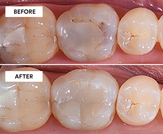 Clinical Case: Minimally Invasive Caries Management | Solventum