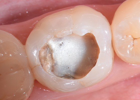 The modern role of liners in adhesive dentistry | Solventum