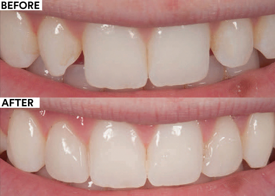 Clinical Case: Aesthetic and Conservative Bonding for Small Laterals ...